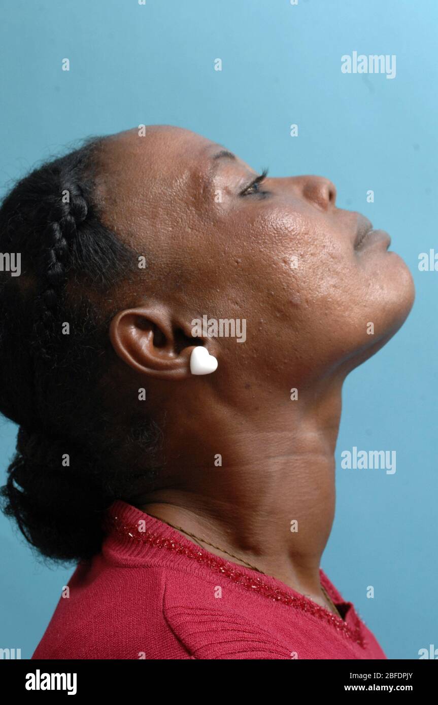 Middle-aged woman suffering from a small toxic goitre Stock Photo - Alamy