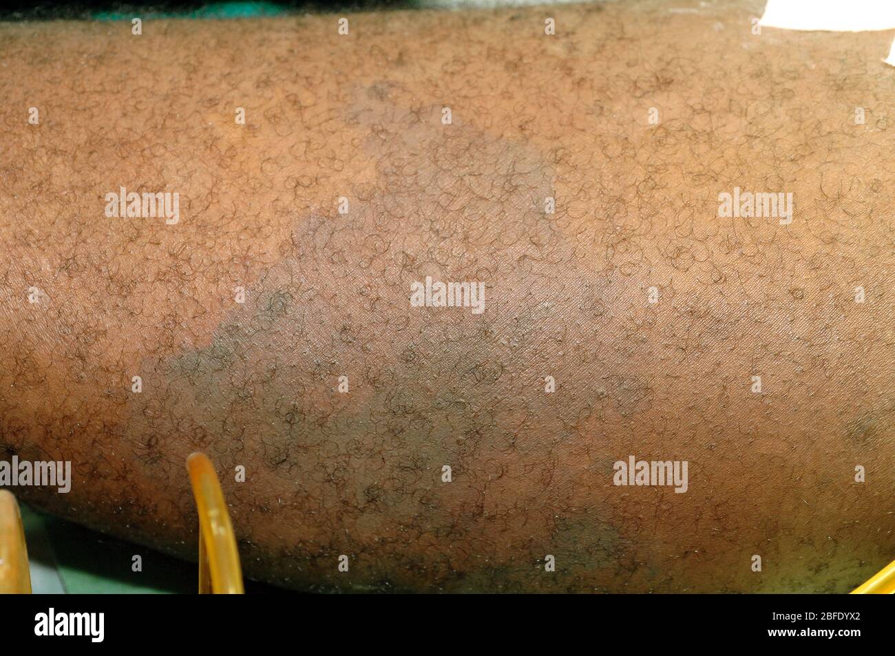 Sepsis skin hi-res stock photography and images - Alamy