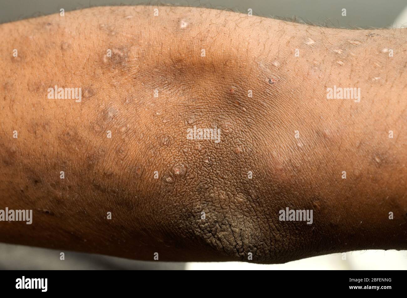 Psoriasis Arm