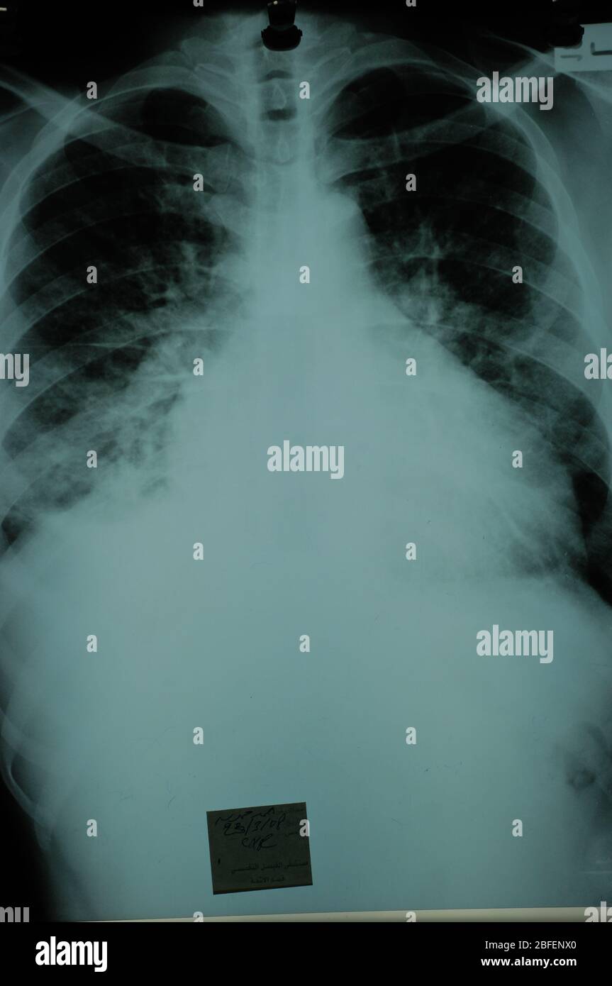 Close-up of an x-ray of the human chest Stock Photo - Alamy