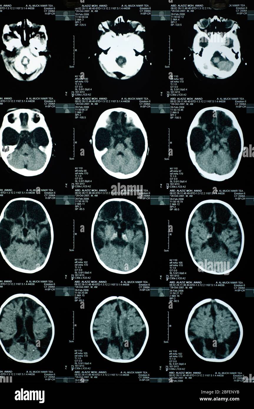 A close-up from a series of CT scans showing an infants skull Stock ...