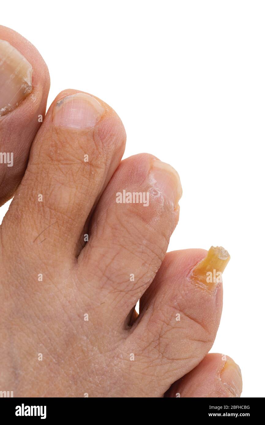 Close up view of male foot with deformed toenails on white background ...