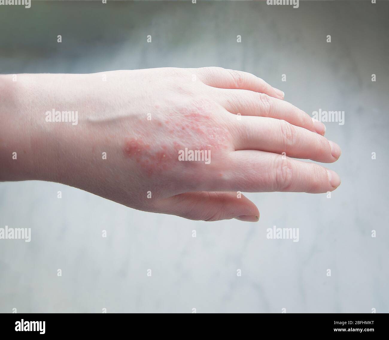 hand closeup skin disease psoriasis Stock Photo - Alamy
