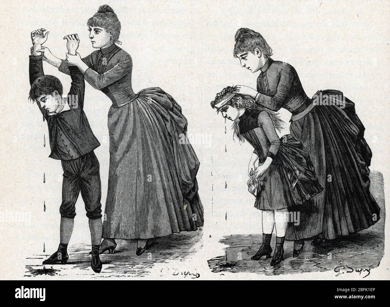 epistaxis - children with Nosebleed - engraving Stock Photo - Alamy