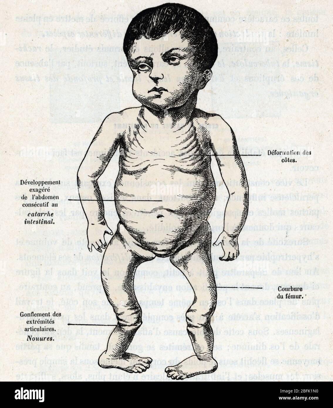 Rickets child hi-res stock photography and images - Alamy