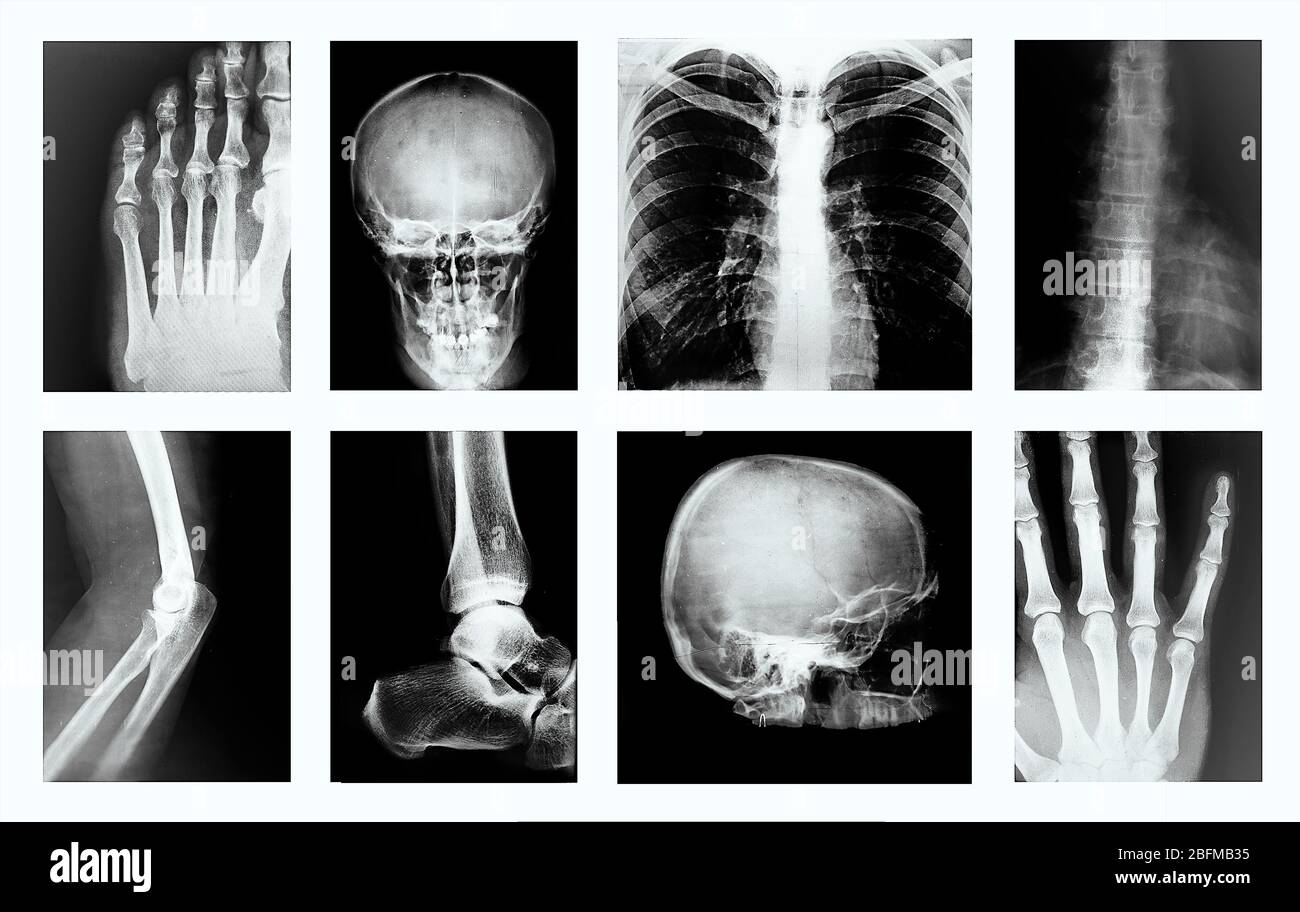 Collage of many X-rays Stock Photo - Alamy