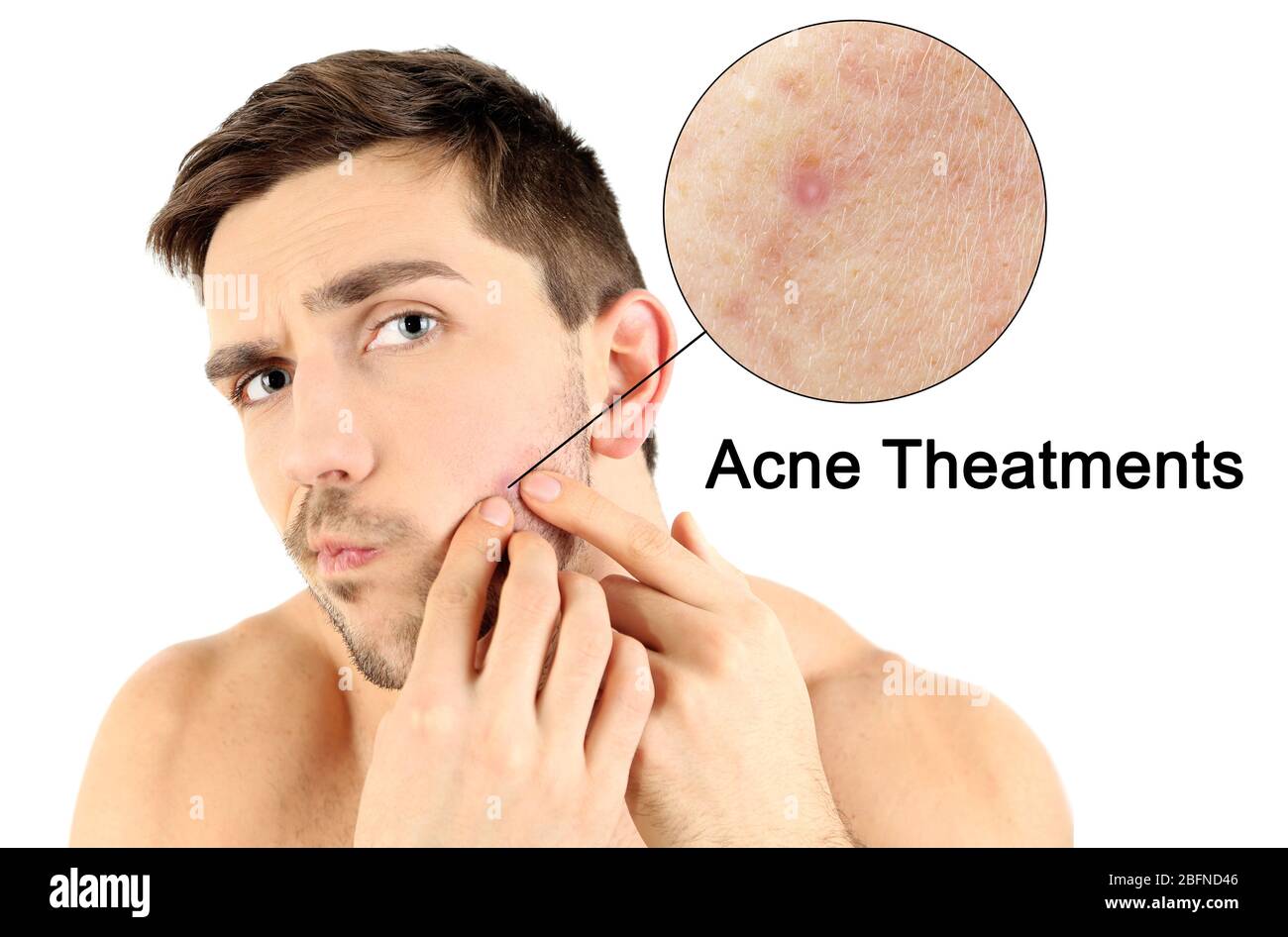 Skin care concept. Young man squeezing pimple, white background Stock ...
