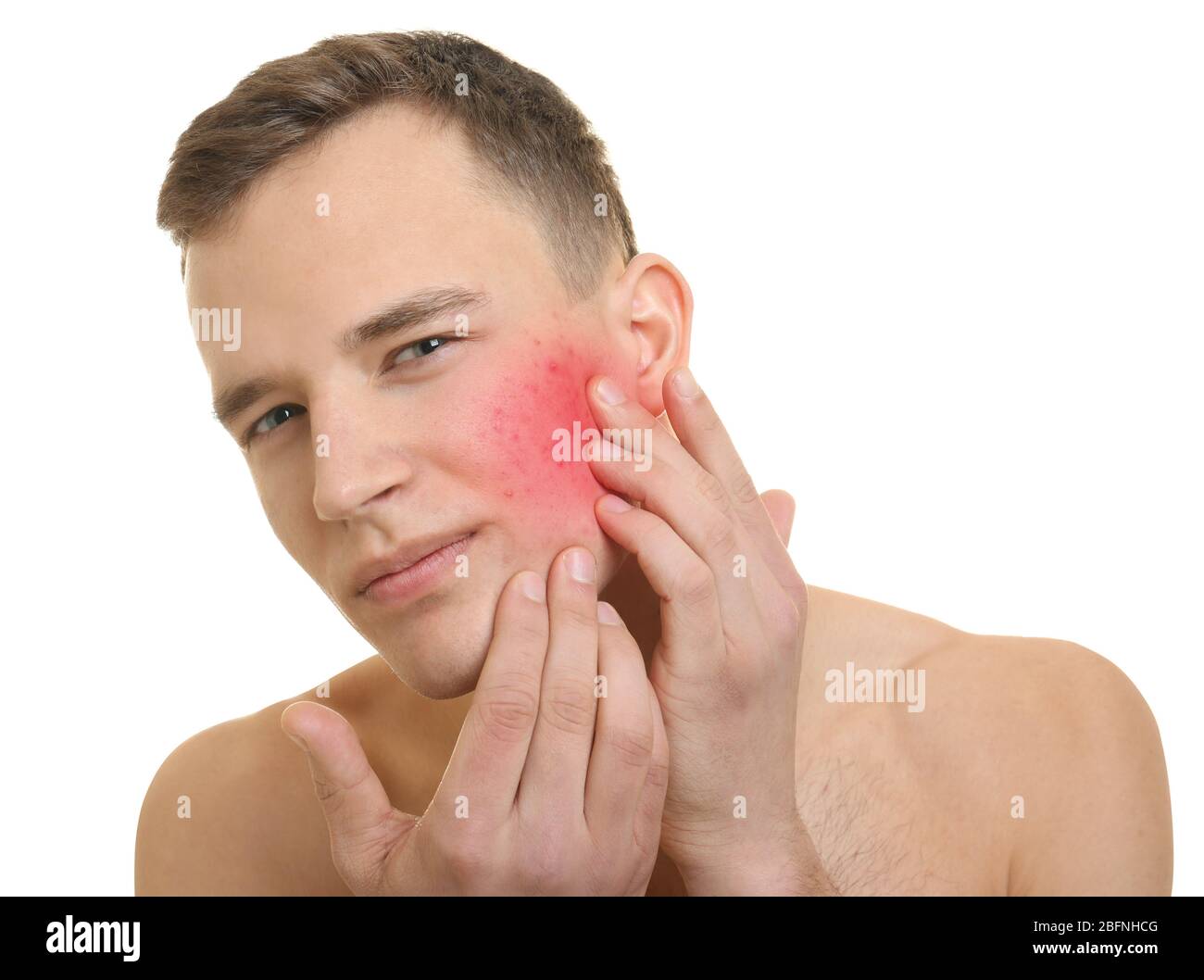 Skin care concept. Young man with acne on white background Stock Photo ...