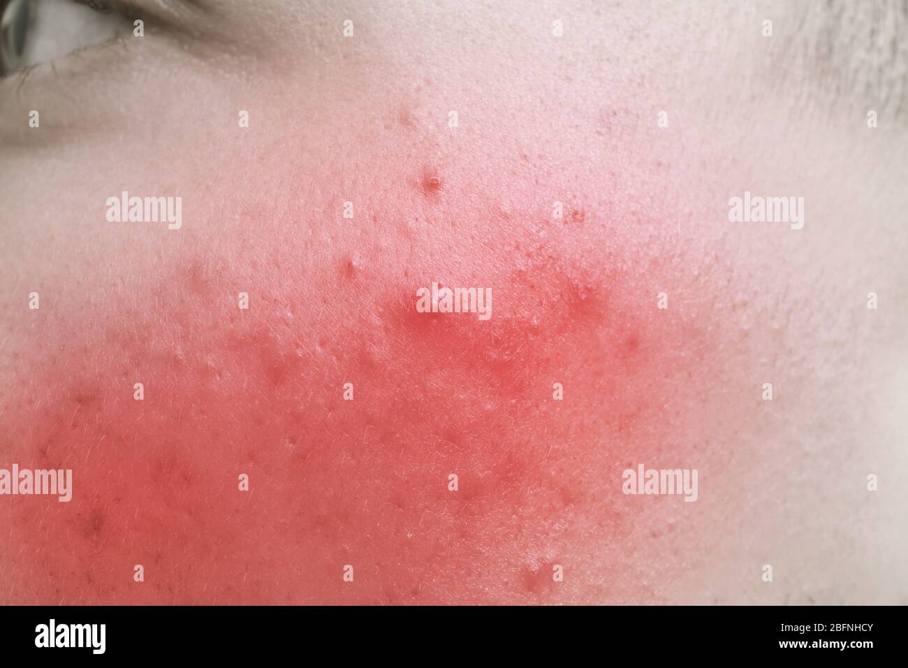 Skin Irritation High Resolution Stock Photography and Images - Alamy