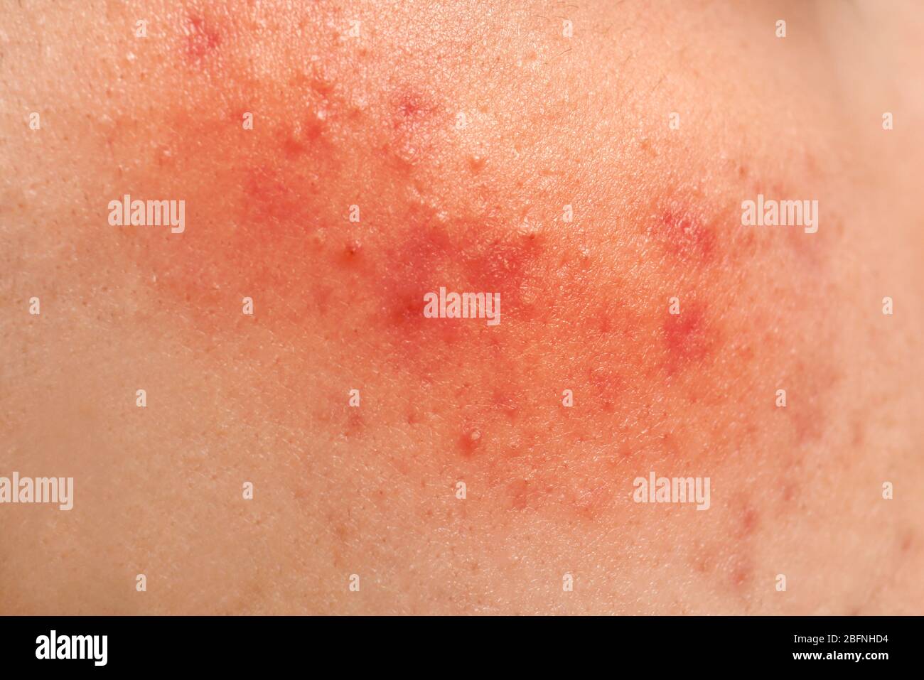 Rashes and skin irritation hi-res stock photography and images - Alamy