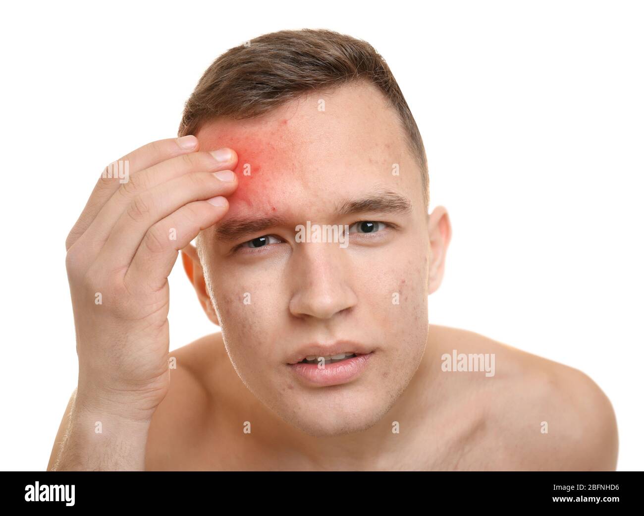 Skin care concept. Young man with acne on white background Stock Photo ...