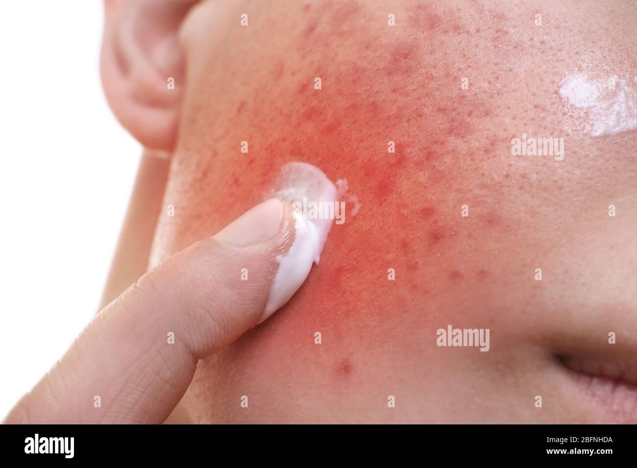 Skin rashes cream hi-res stock photography and images - Alamy