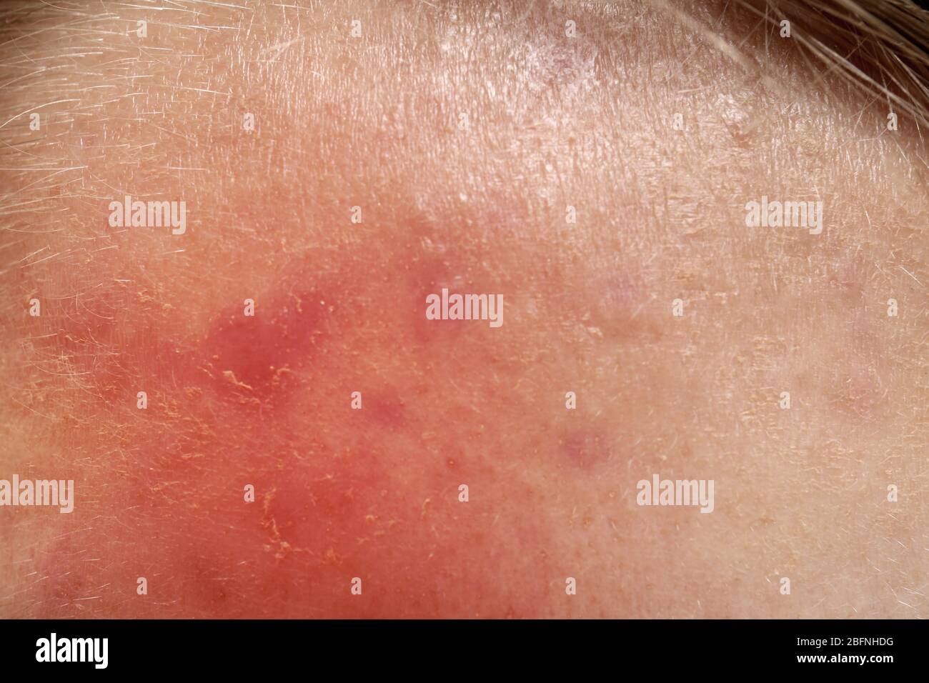 Anti skin rashes hi-res stock photography and images - Alamy