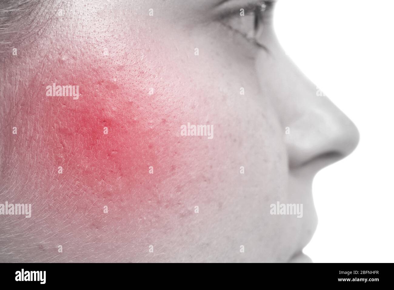 Skin care concept. Young woman with acne, closeup Stock Photo - Alamy
