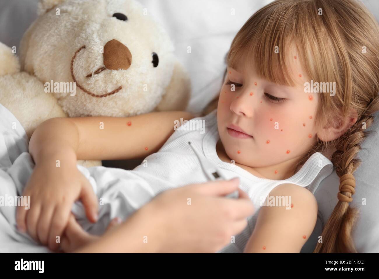 Little girl chicken pox hi-res stock photography and images - Alamy