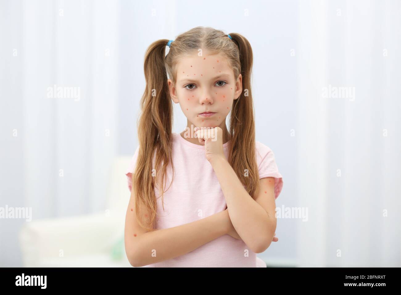 Little girl with red pimples at home. Chicken pox concept Stock Photo ...
