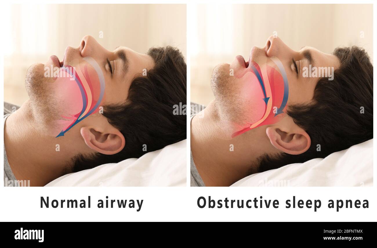 Airway Anatomy Stock Photos & Airway Anatomy Stock Images - Alamy
