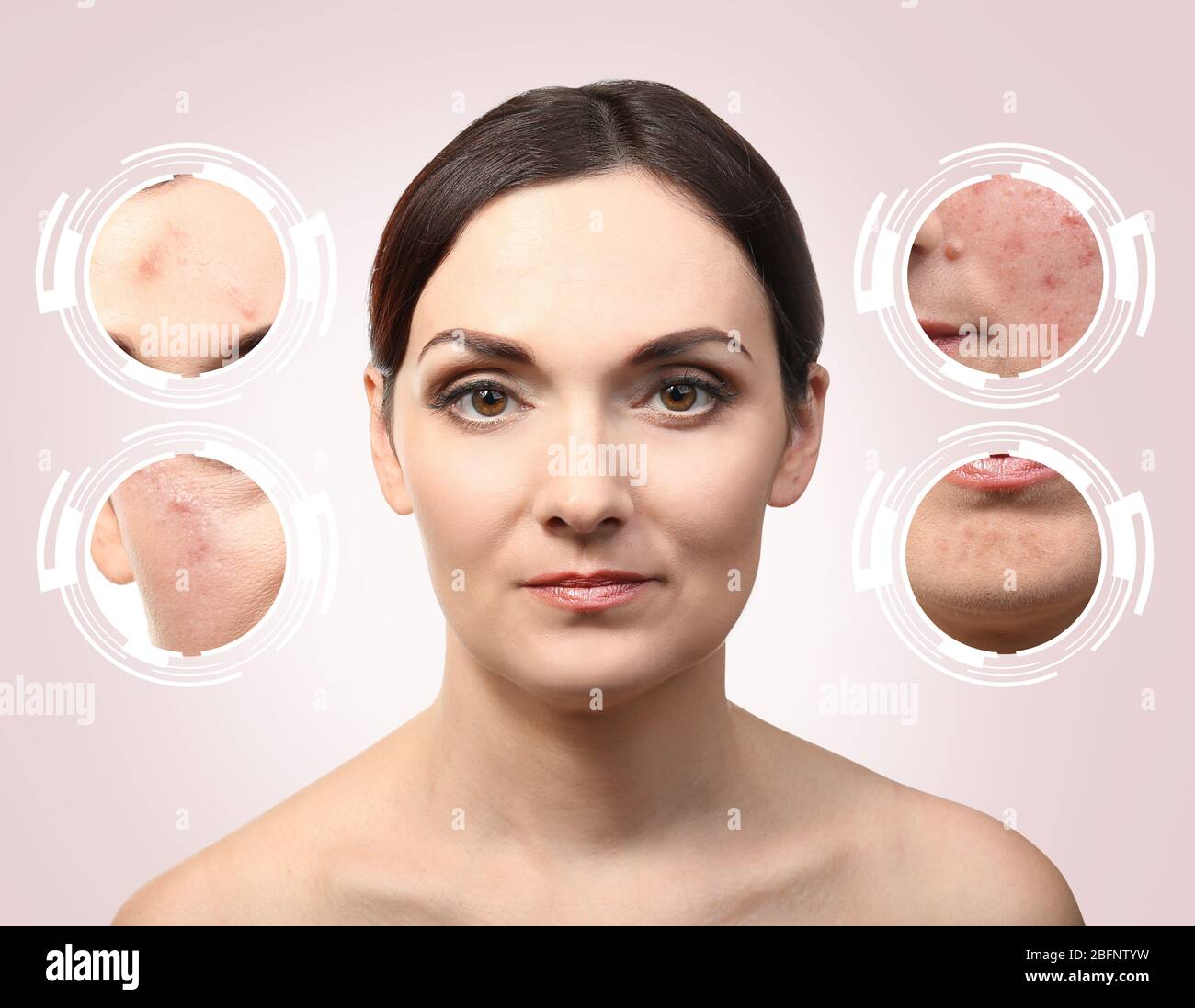 Woman face before and after acne treatment procedure. Skin care concept ...