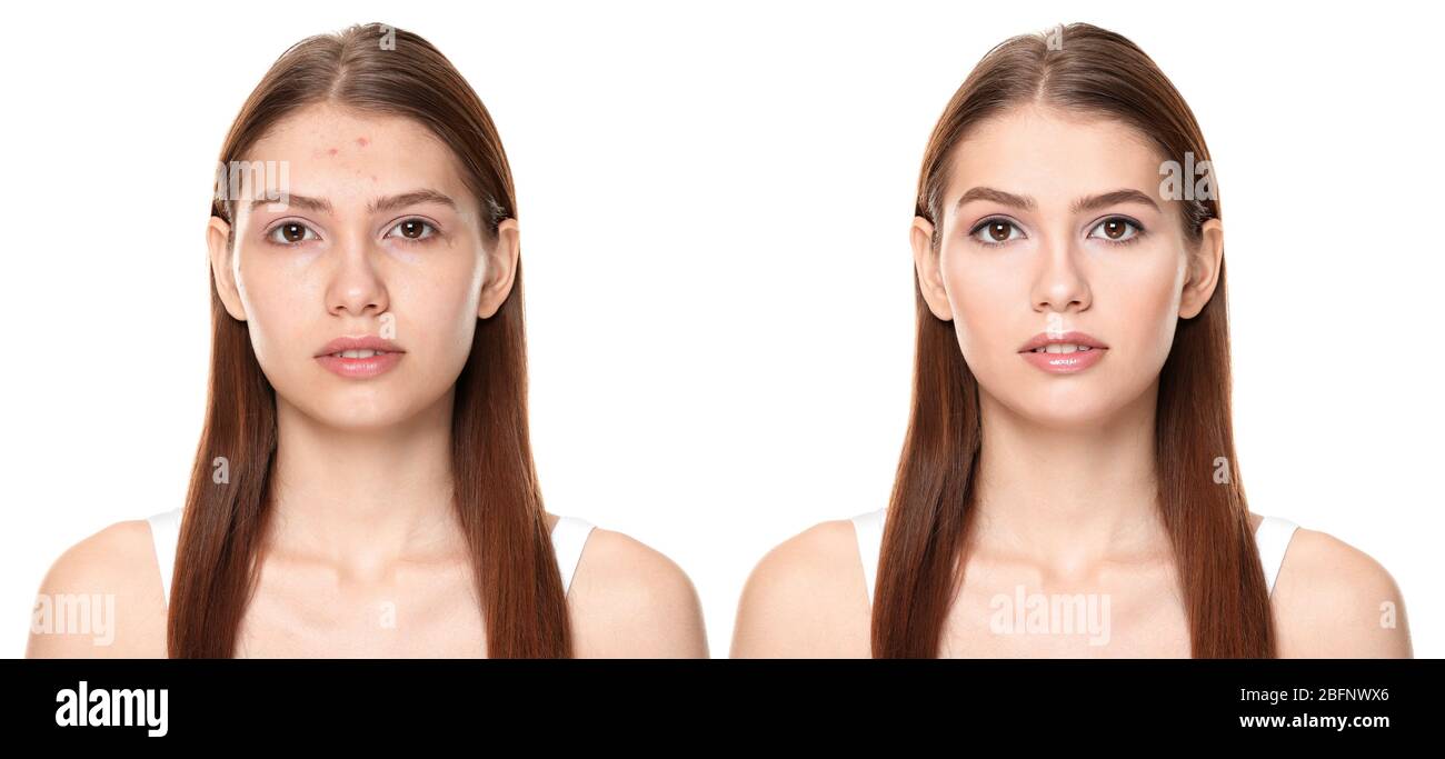Young woman before and after makeup application on white background ...