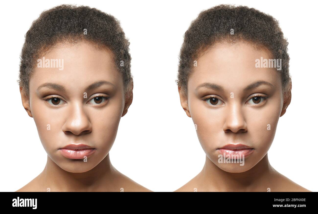 Young African-American woman before and after rhinoplasty on white ...
