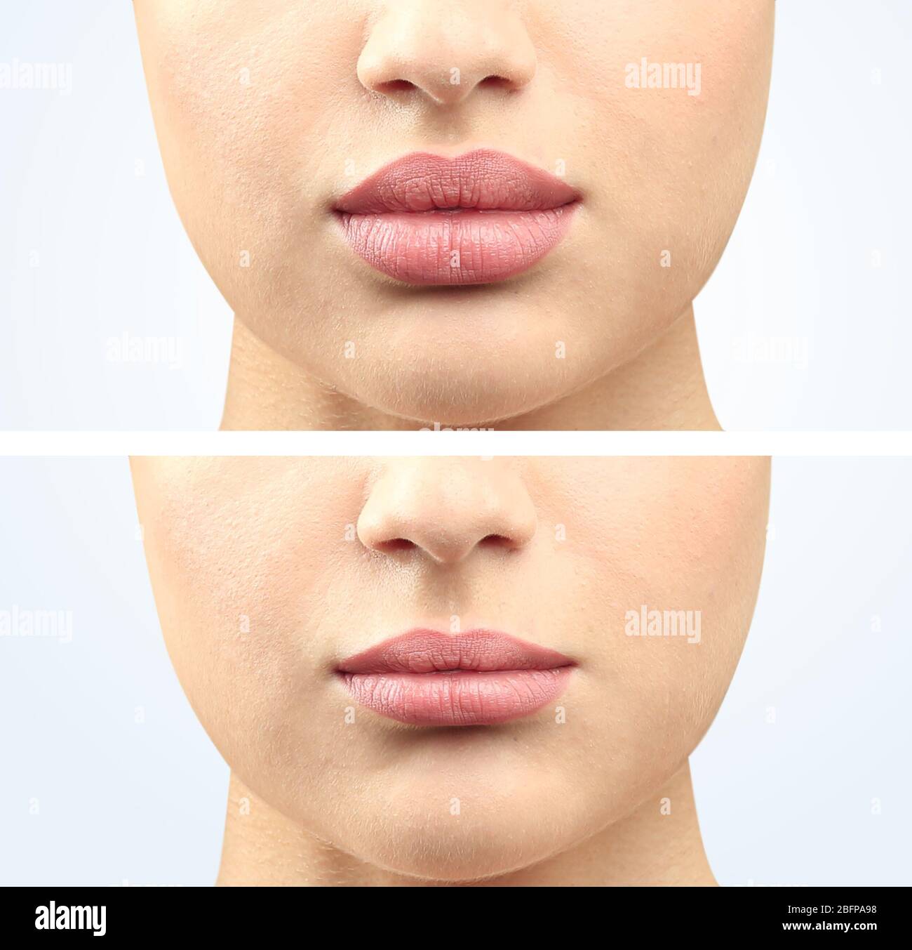 Woman lipc before and after cosmetic procedure. Plastic surgery concept ...