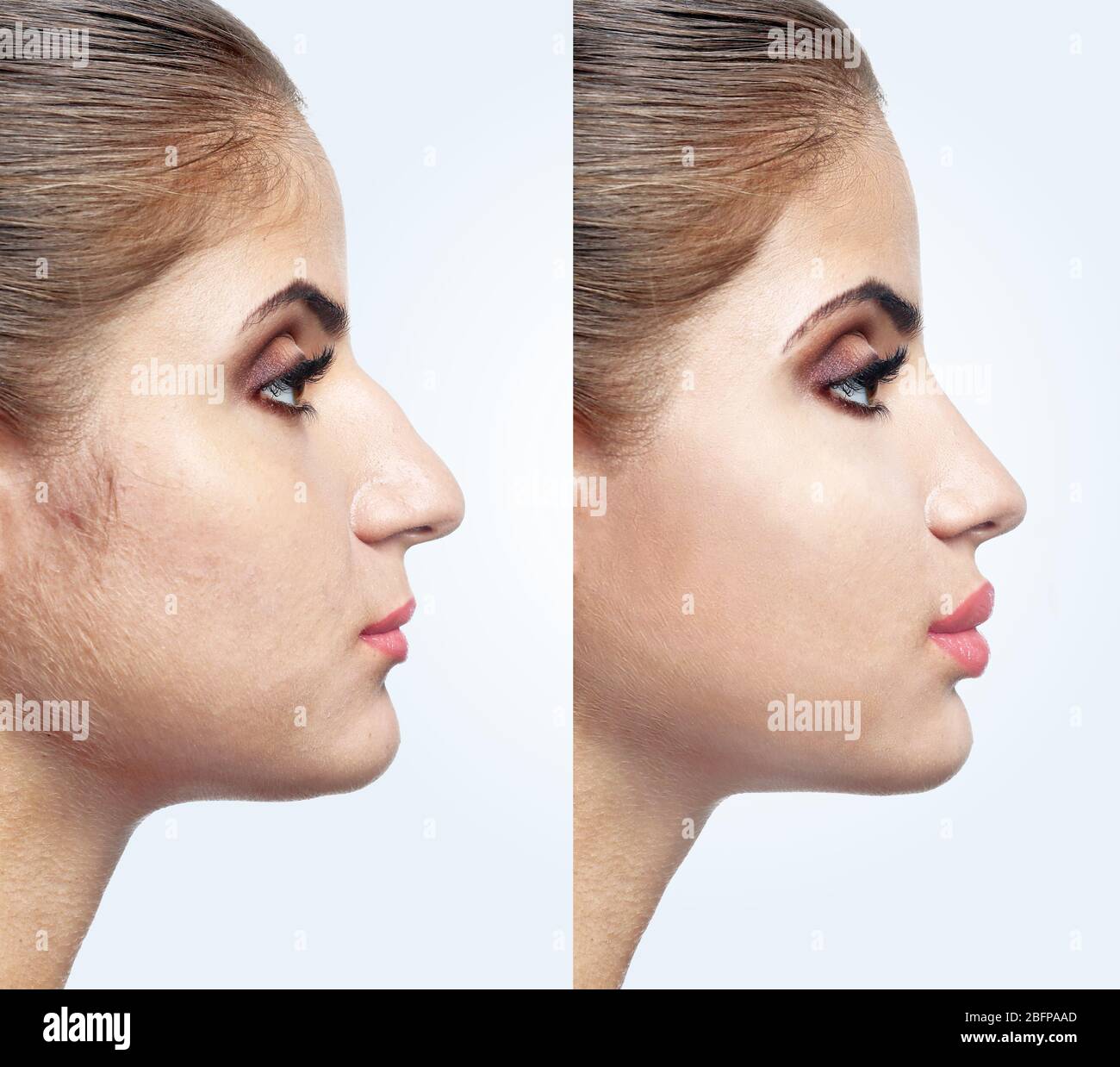 Woman face before and after cosmetic procedure. Plastic surgery concept ...