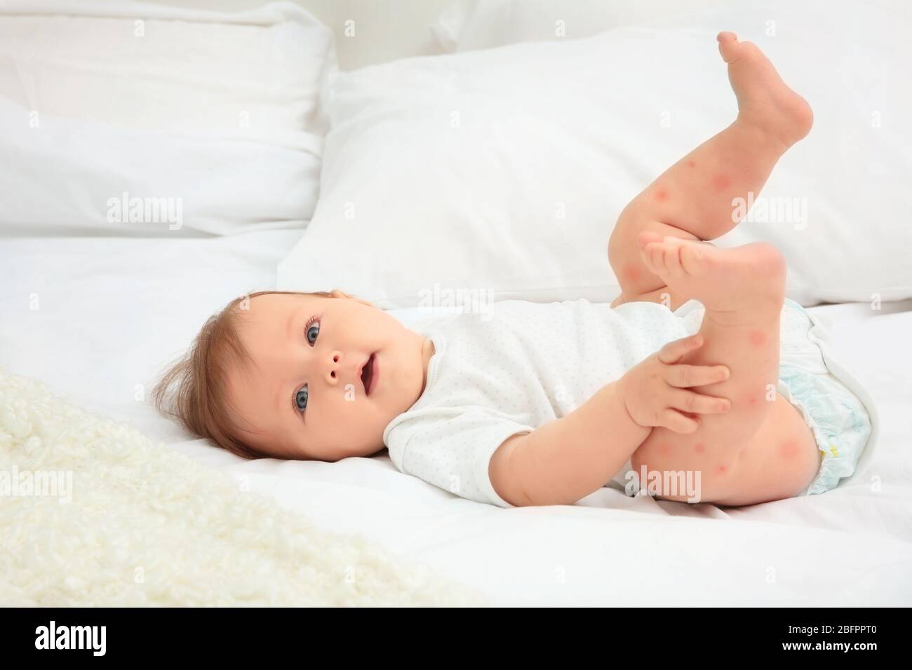 Little child with red rash lying on bed. Concept of babies allergies ...