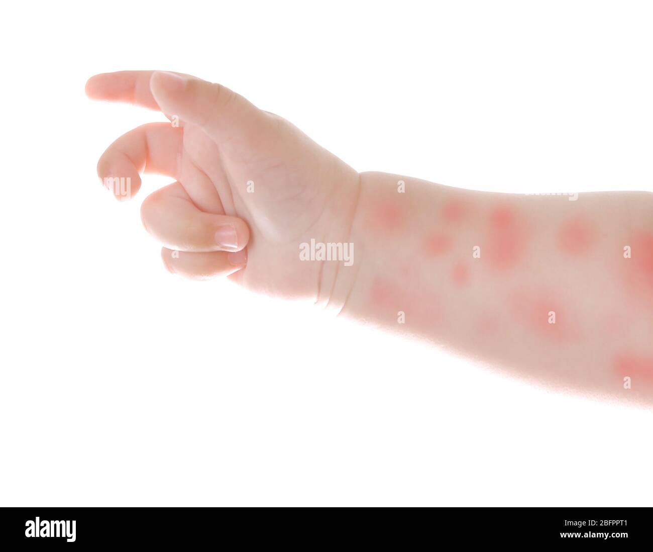 Hand of little child with red rash on white background, closeup ...