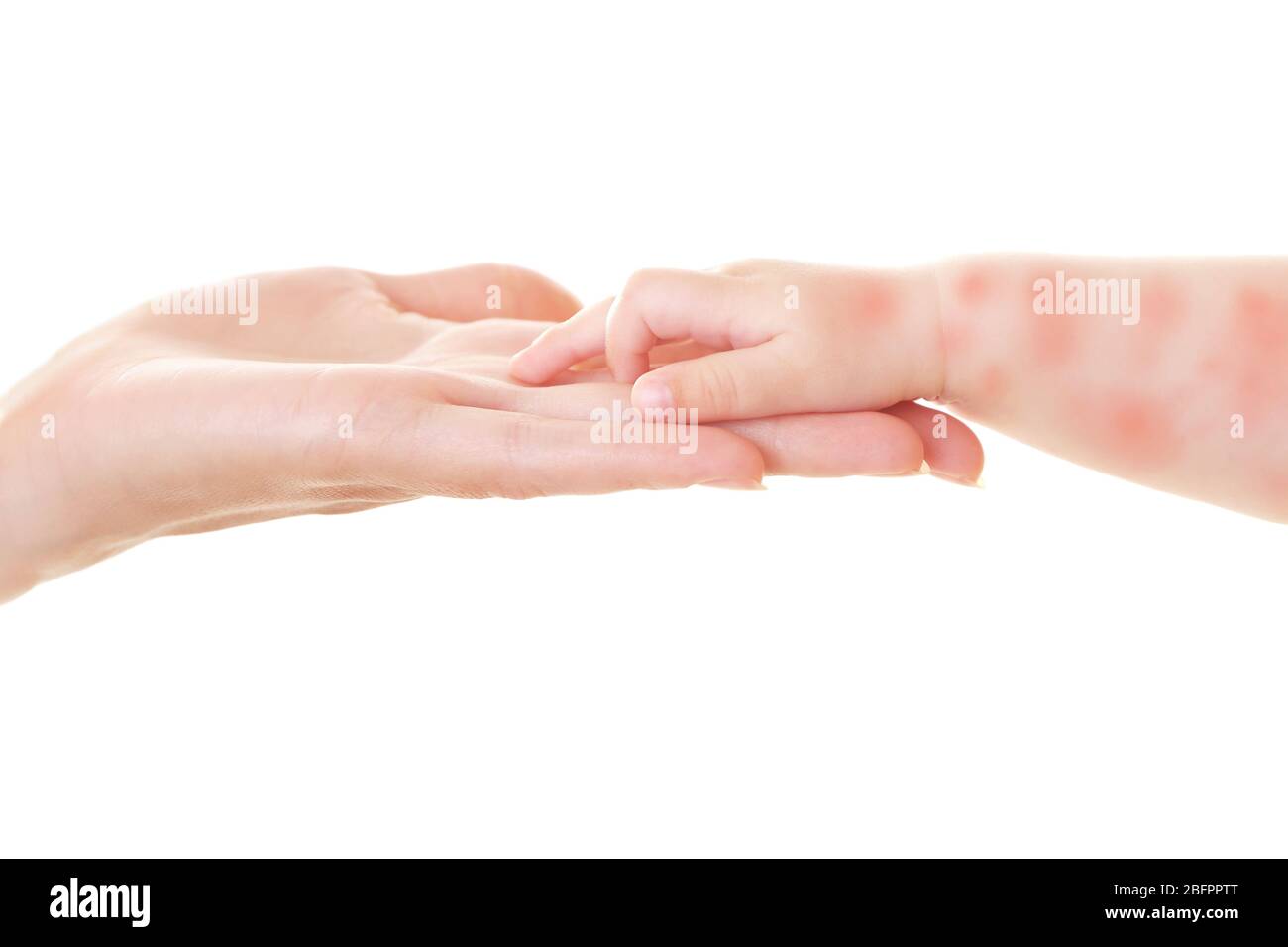 Mother holding hand of little child with red rash on white background ...