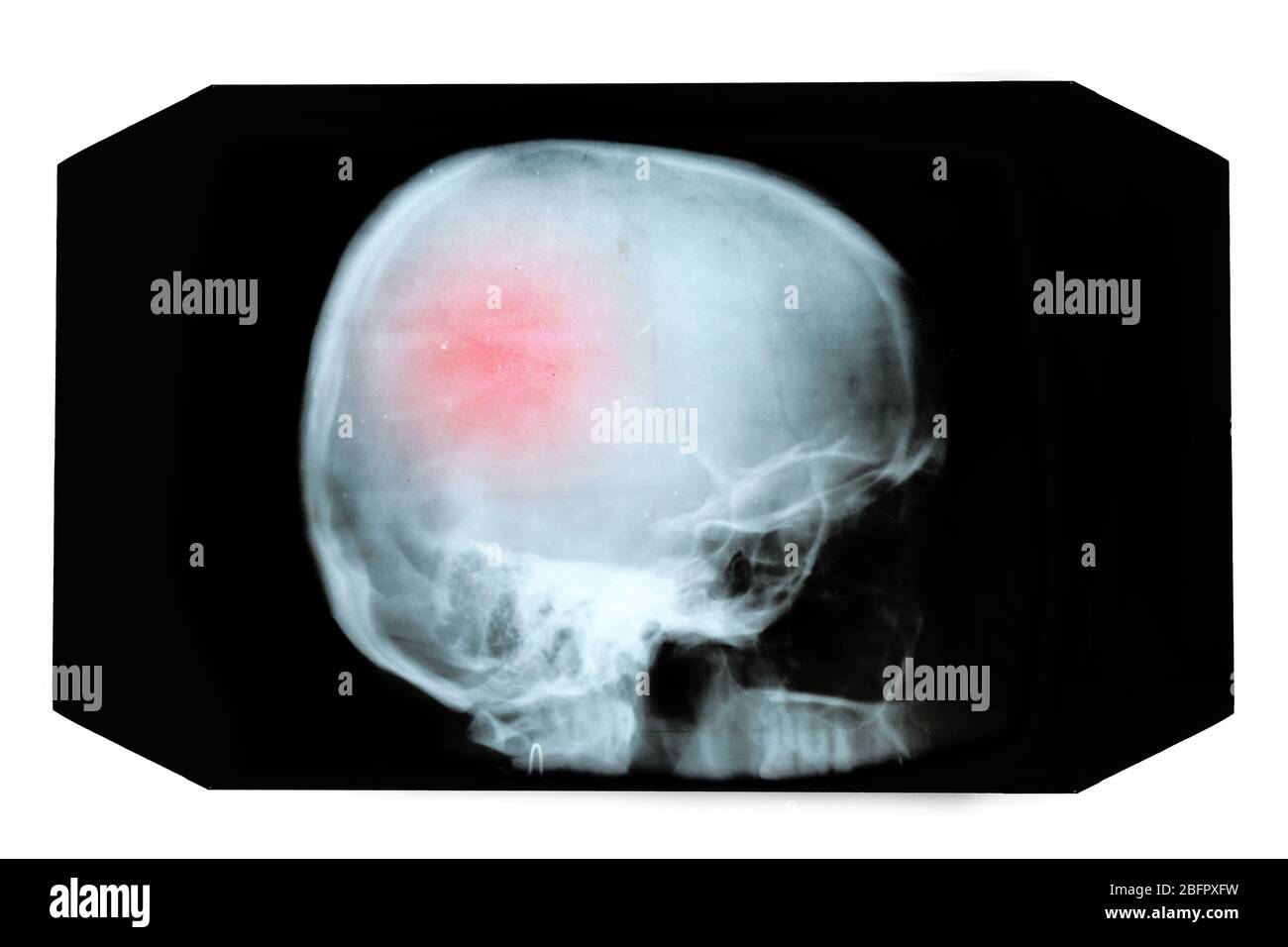X Ray Pictures Of Jaw Bone Cancer at Eileen Towner blog