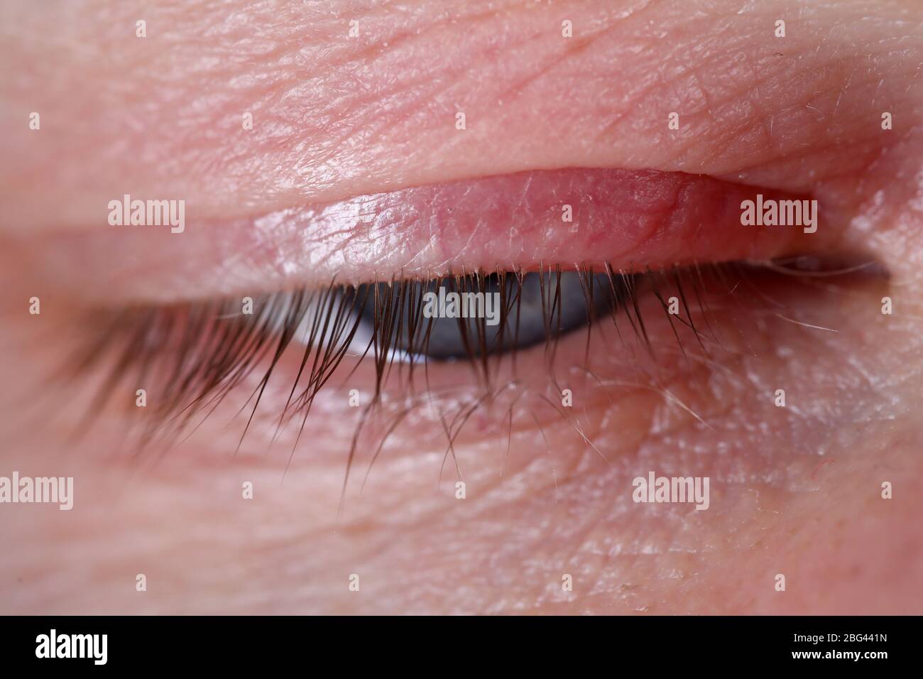 Sty on human eye closeup skin disease Stock Photo - Alamy