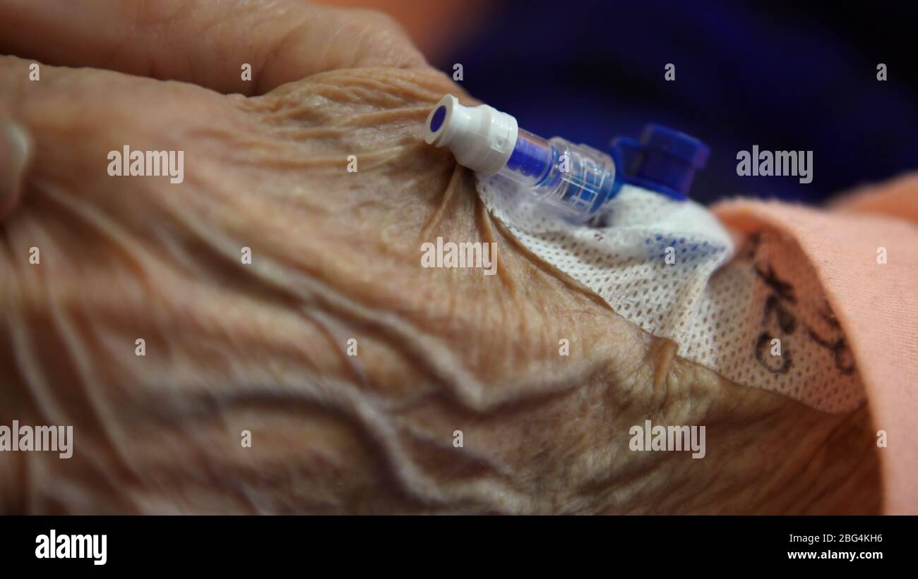 Intravenous cannula placed in the hand of an elderly patient for ...