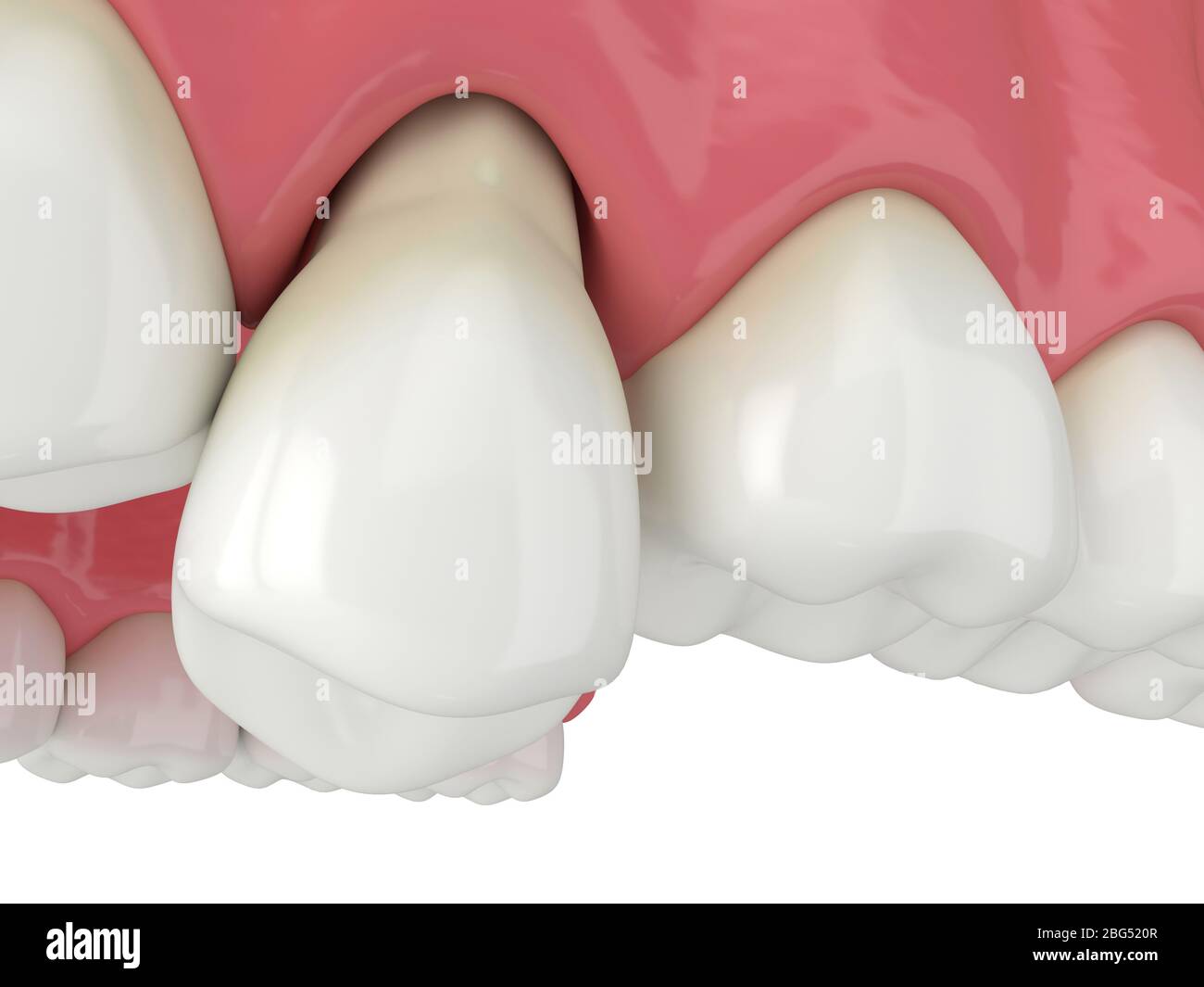 Protruding teeth hi-res stock photography and images - Alamy