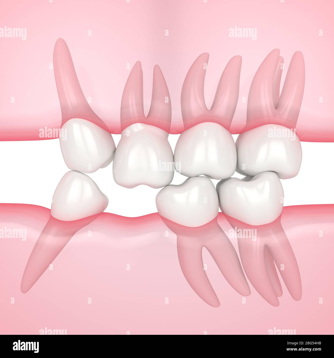 3d render of teeth sliding towards the area of missing tooth in order ...