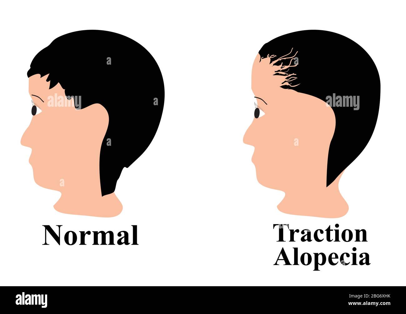 Alopecia Hair Baldness Of Hair On The Head Traction Alopecia