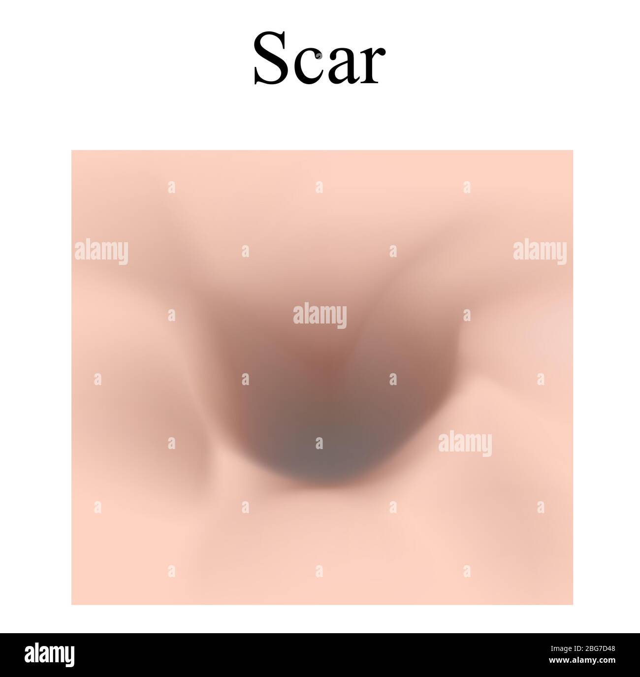 Atrophic scars. Acne scar. The anatomical structure of the skin with ...