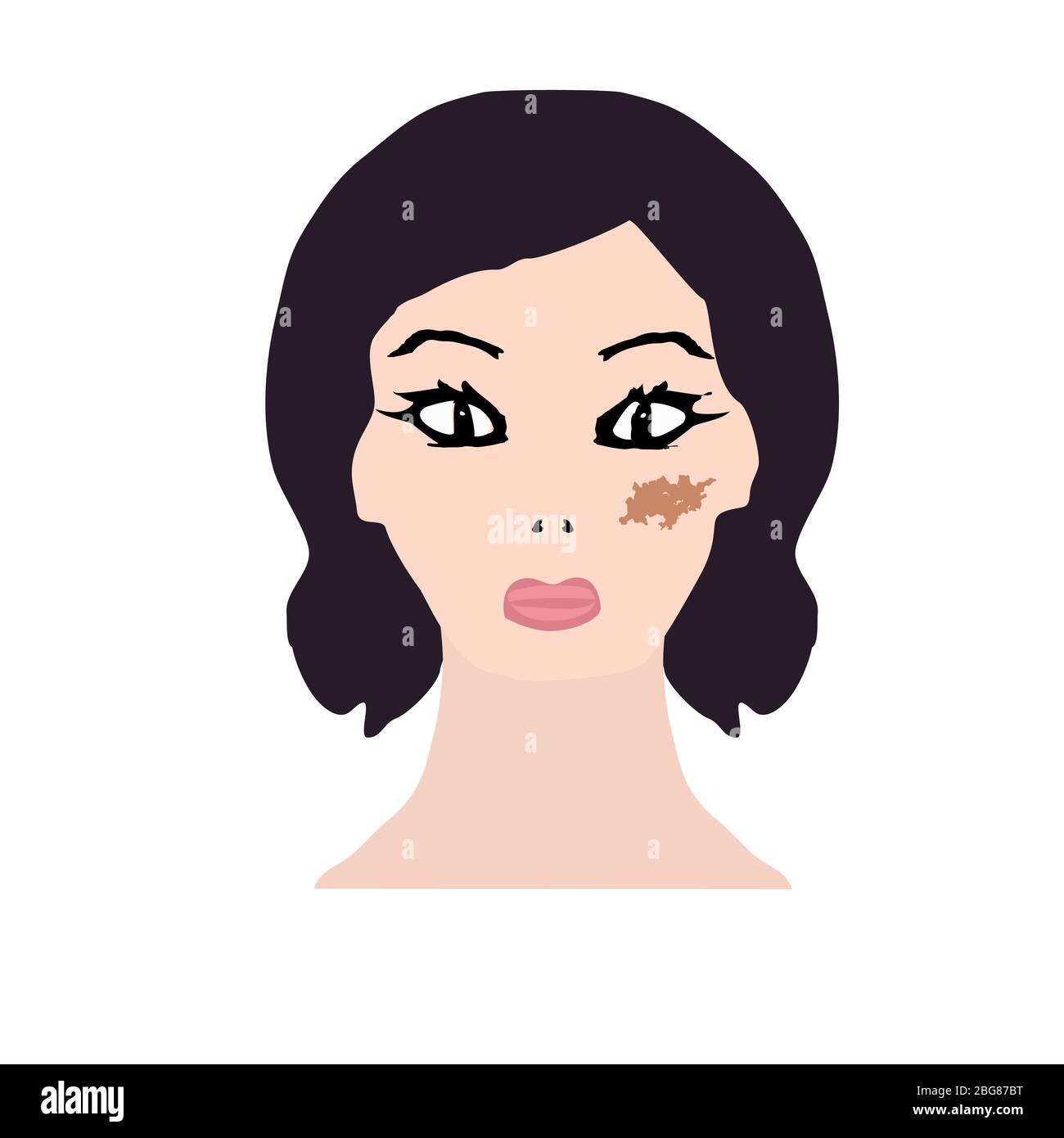 Pigmentation on the skin. A pigmented spot on the skin of the face ...