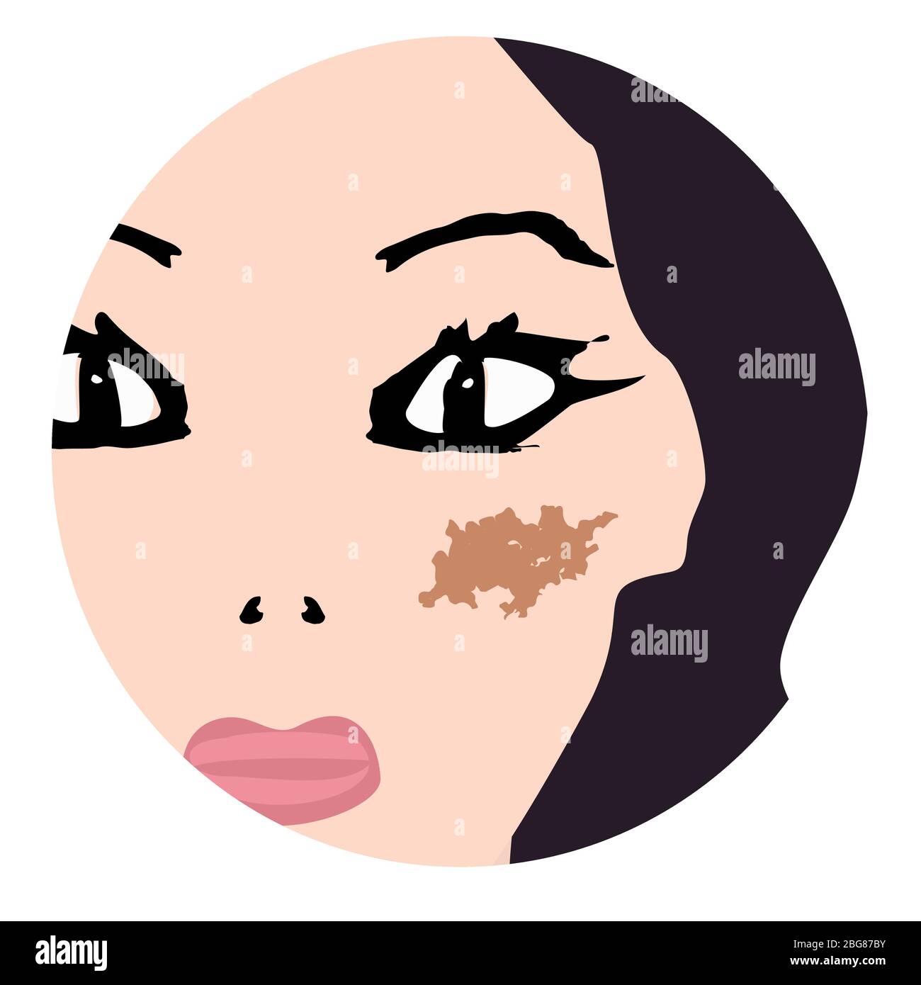 Pigmentation on the skin. A pigmented spot on the skin of the face ...