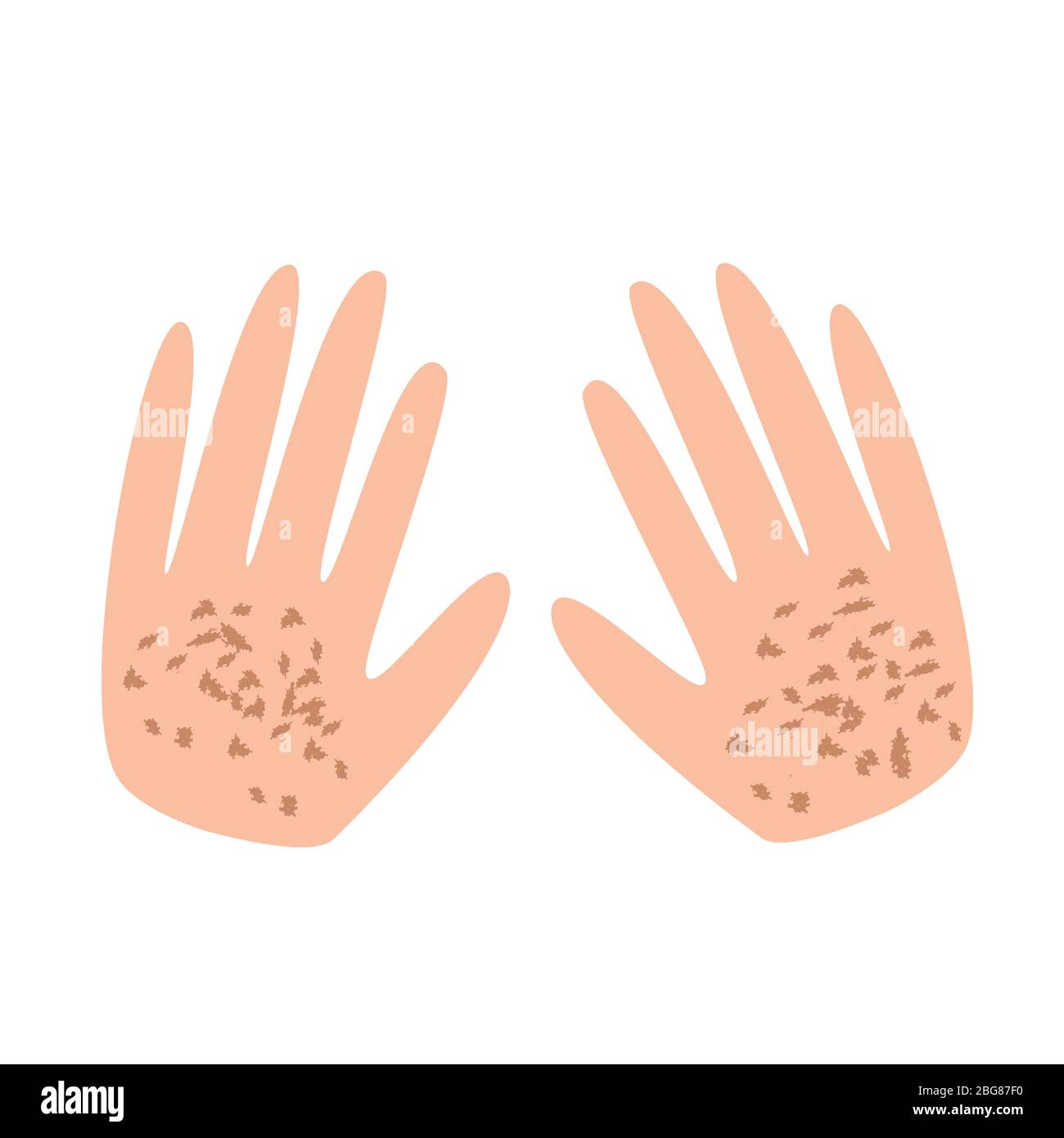 Freckles on the hands. Pigmentation on the skin. A pigmented spot on ...