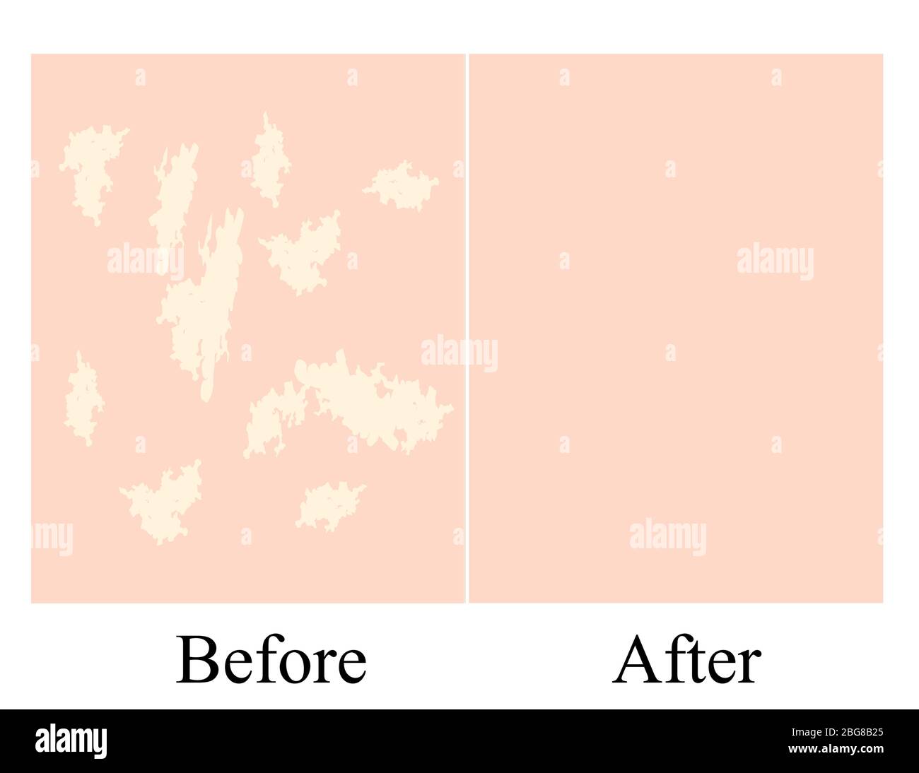 Vitiligo. White spots on the skin. Infographics vector illustration ...