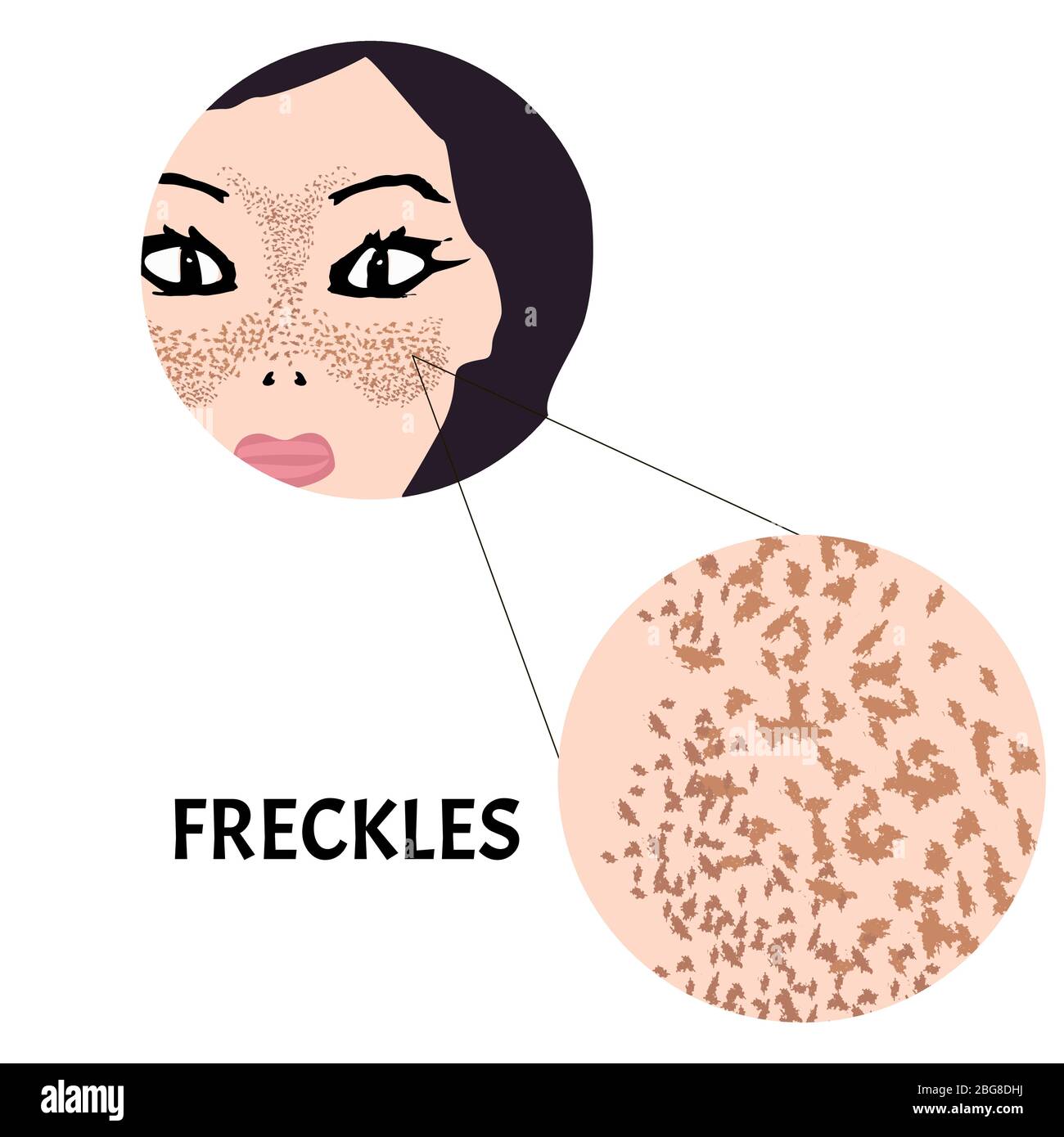 Freckles on the face. Pigmentation on the skin. A pigmented spot on the ...