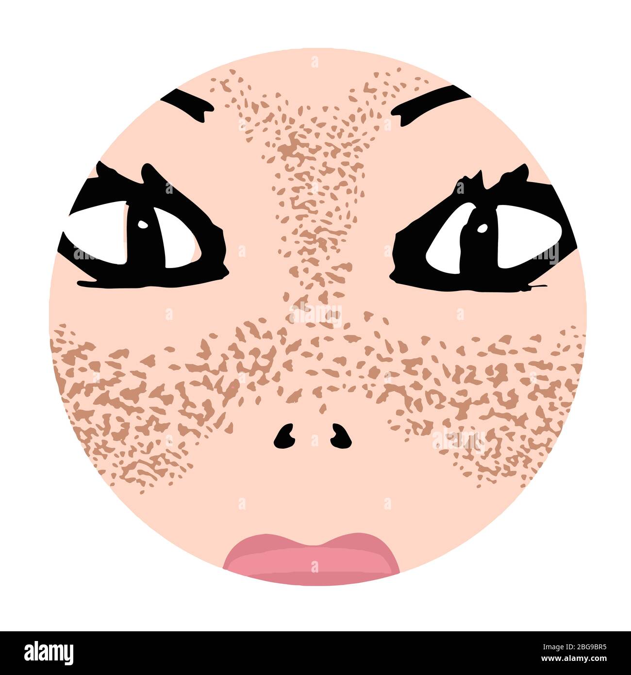 Freckles on the face. Pigmentation on the skin. A pigmented spot on the ...