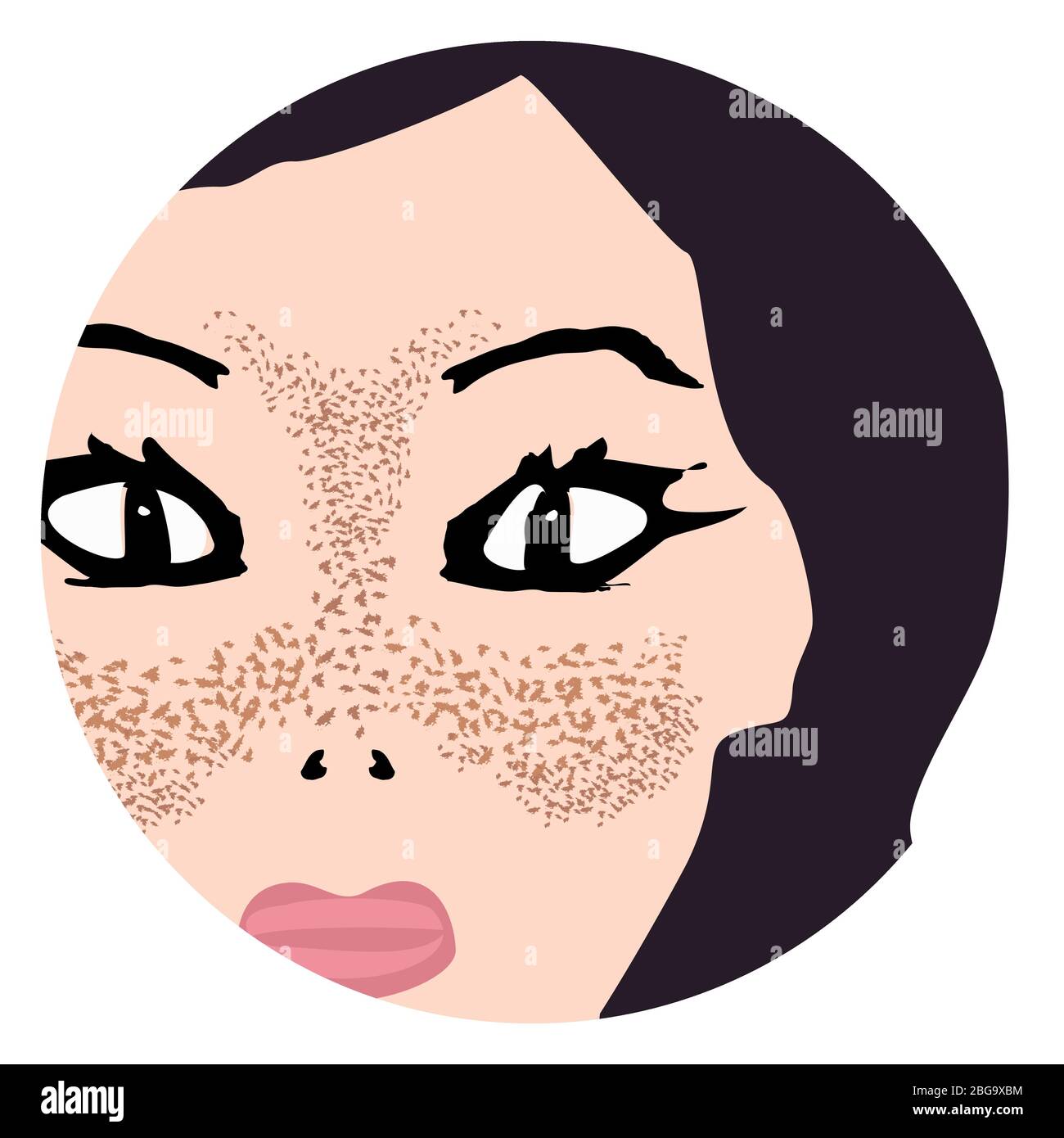 Freckles on the face. Pigmentation on the skin. A pigmented spot on the ...