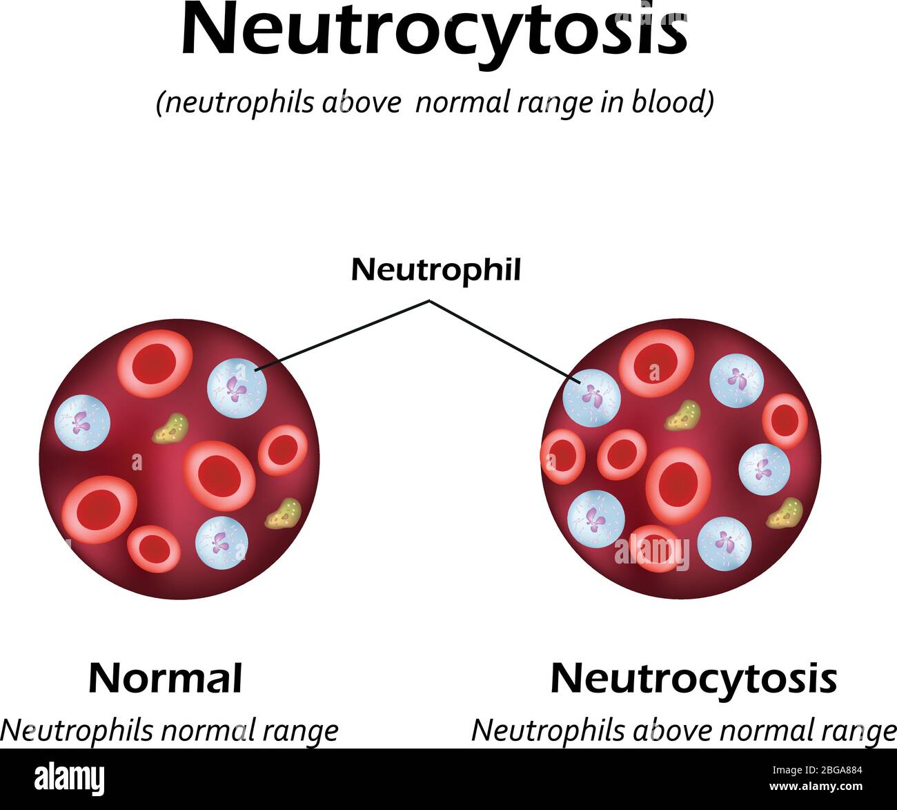 Neutrophils Normal Range Hematology: Platelets (Qualitative And