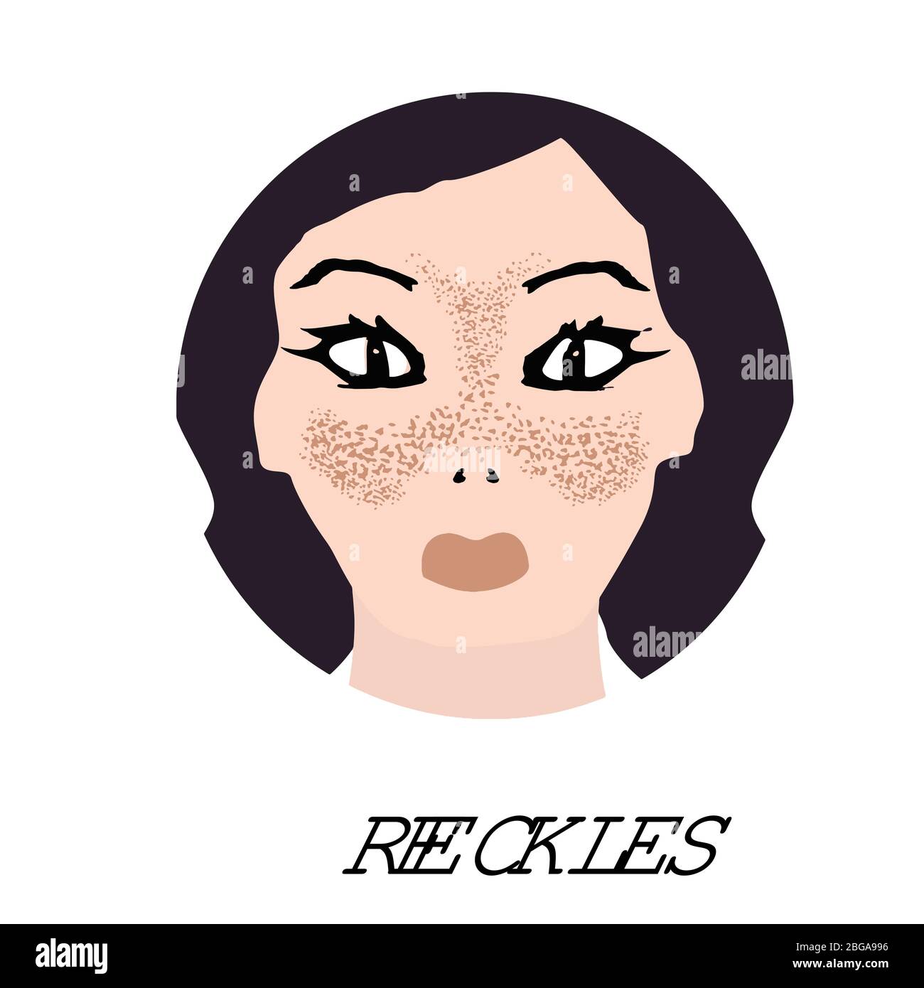 Freckles on the face. Pigmentation on the skin. A pigmented spot on the ...