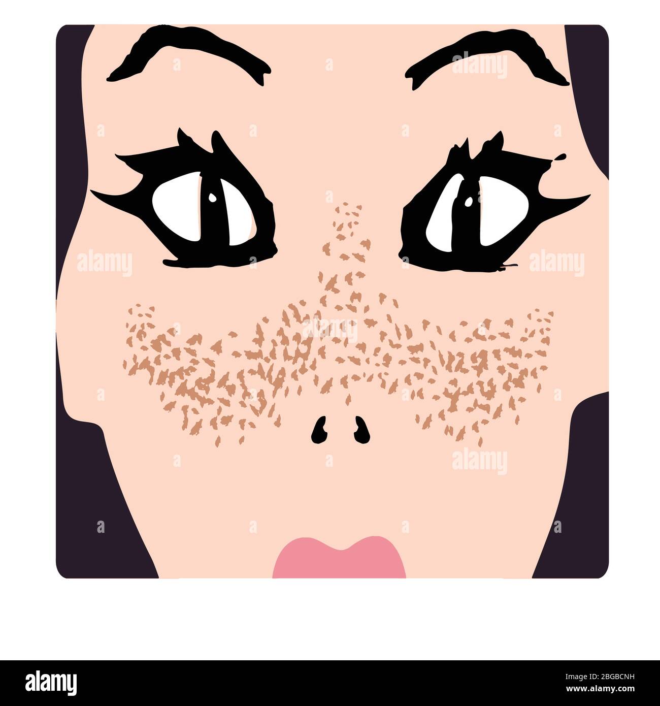 Freckles on the face. Pigmentation on the skin. A pigmented spot on the ...