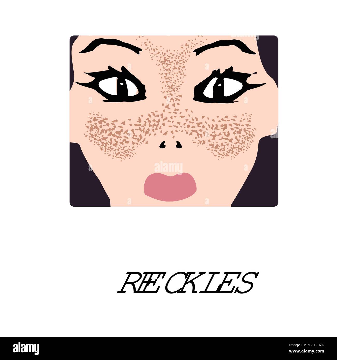 Freckles on the face. Pigmentation on the skin. A pigmented spot on the ...