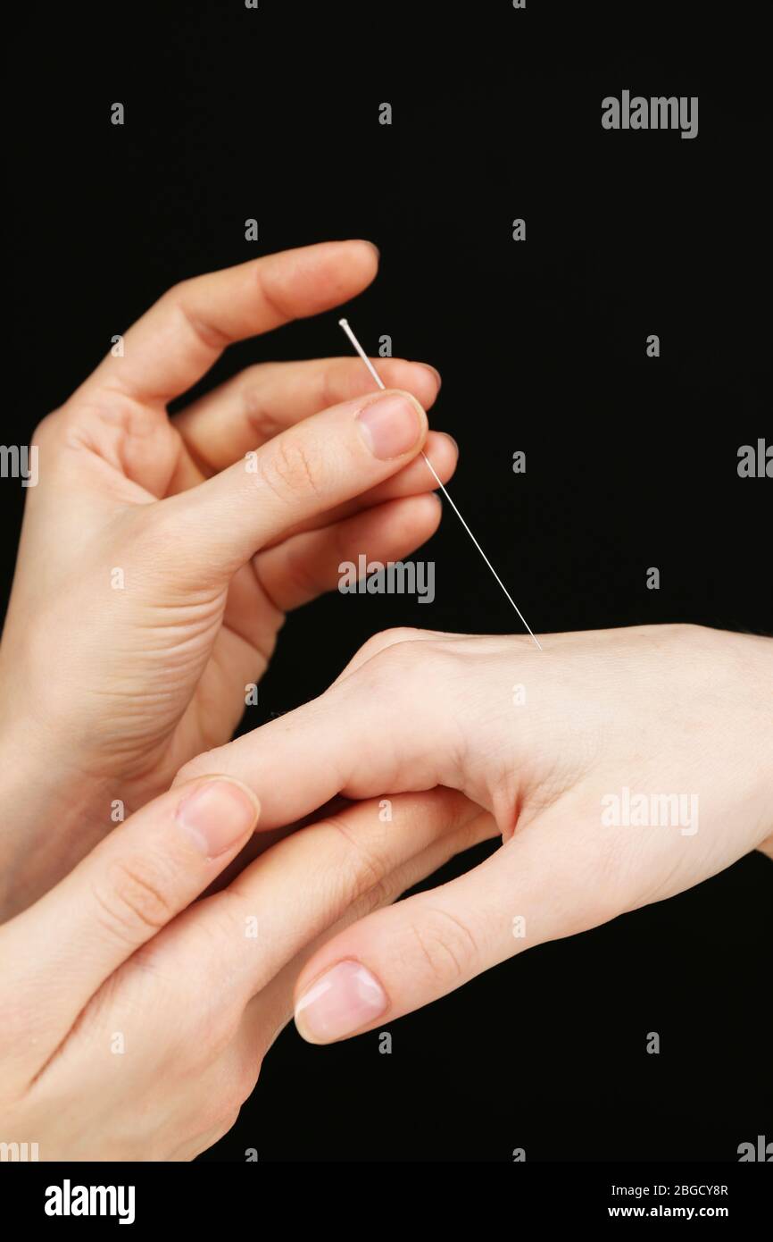 Acupuncture on hand, close up, on dark background Stock Photo - Alamy