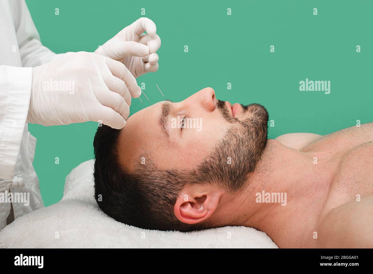 Acupuncturist inserting acupuncture needles into patients skin head ...