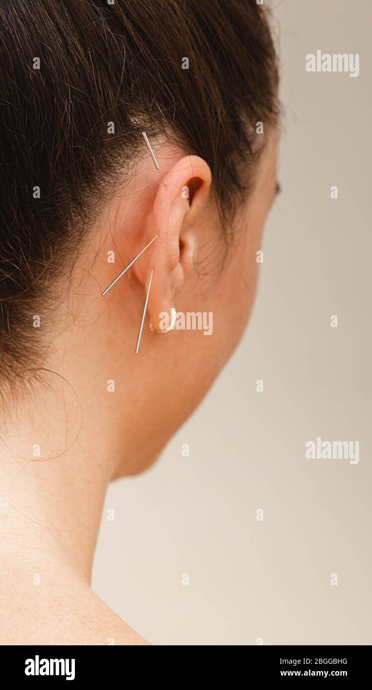 Acupuncture treatment for tobacco or alcohol addiction. Traditional ...